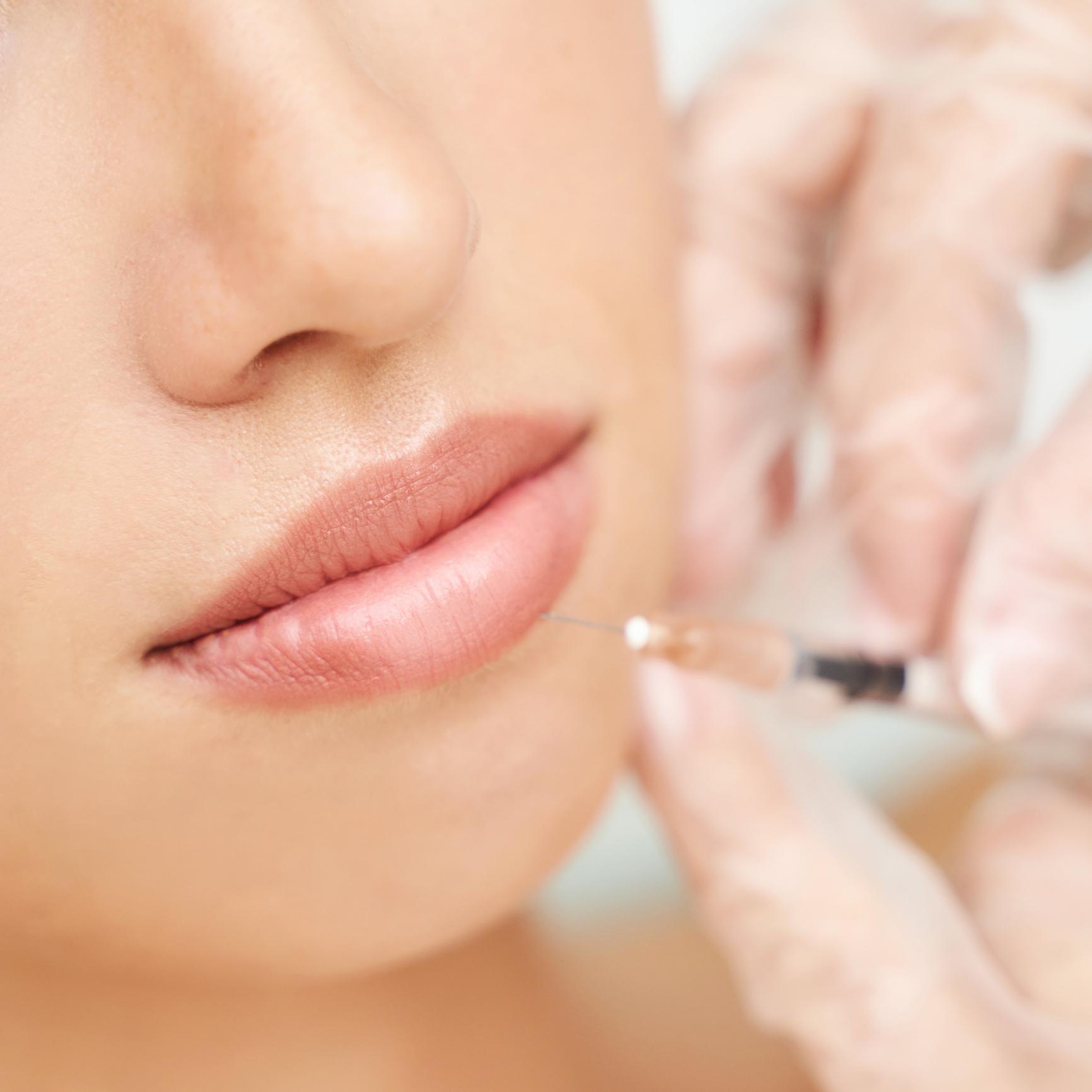 Filler Labbra a Salerno